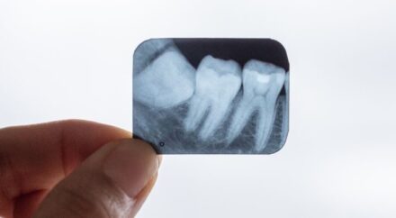 Why Do We Have Wisdom Teeth? - The Fact Site